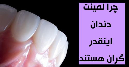 معایب و مزایا لمینت دندان تاریخچه چیست